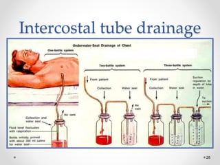 Pneumothorax | PPTX