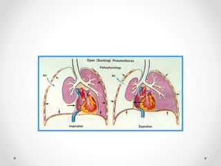 Pneumothorax | PPTX