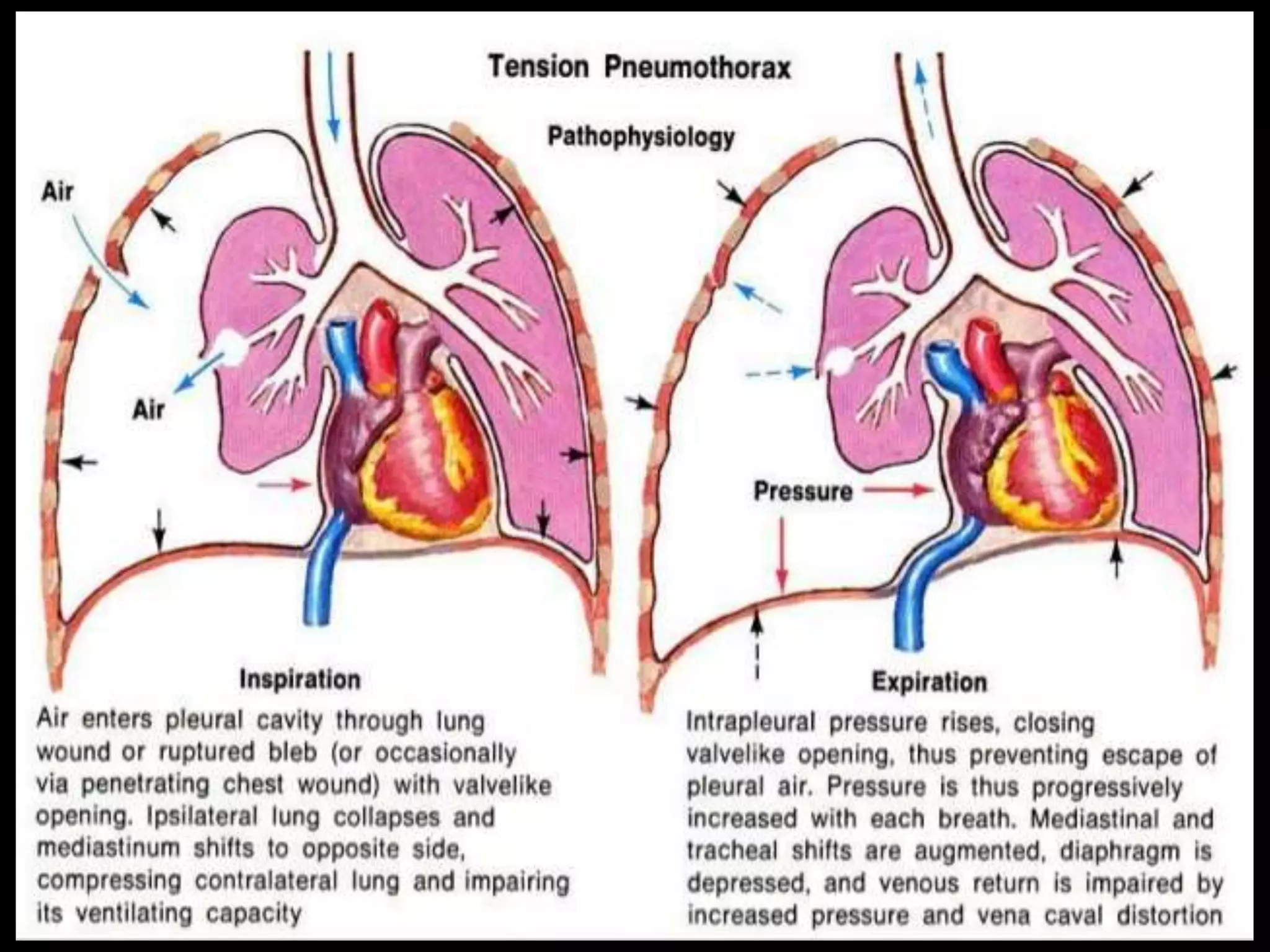 Pneumothorax PPT | PPTX