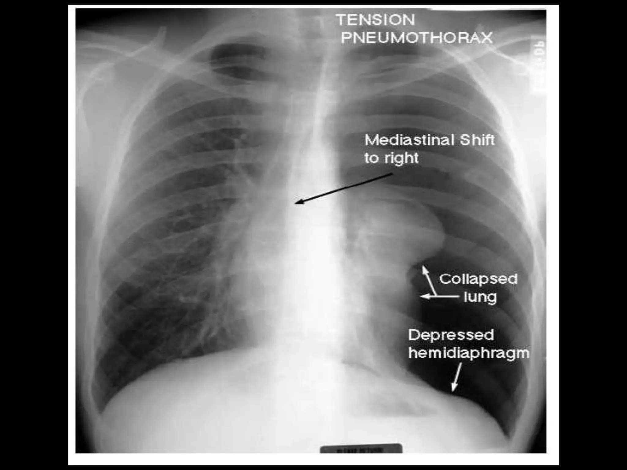 Pneumothorax PPT | PPTX