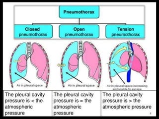 Open Pneumothorax Vs Tension Pneumothorax