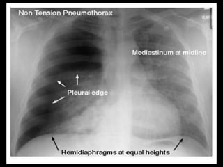 Pneumothorax X Ray