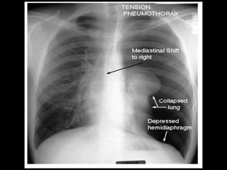 Pneumothorax X Ray