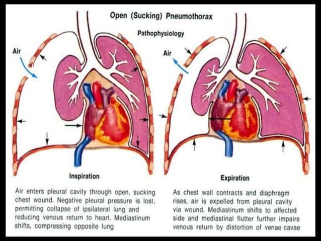 Pneumothorax PPT