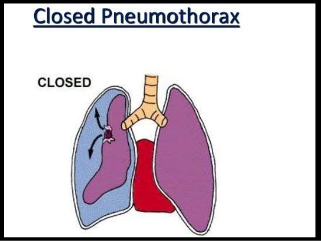 Pneumothorax PPT
