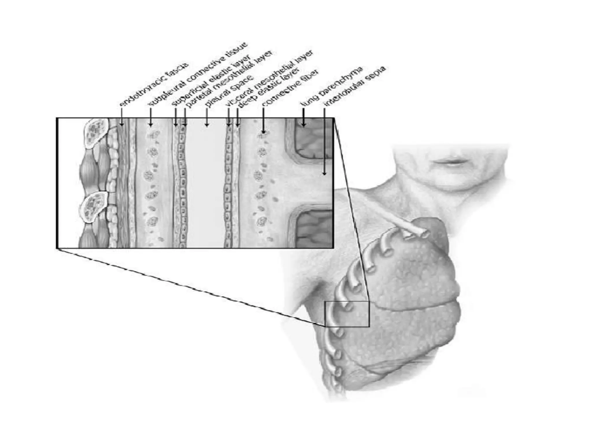 Pneumothorax (surgical management) | PPTX