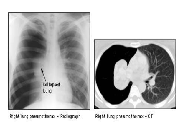 Pneumothorax (surgical management) | PPTX | Lung and Respiratory Health ...