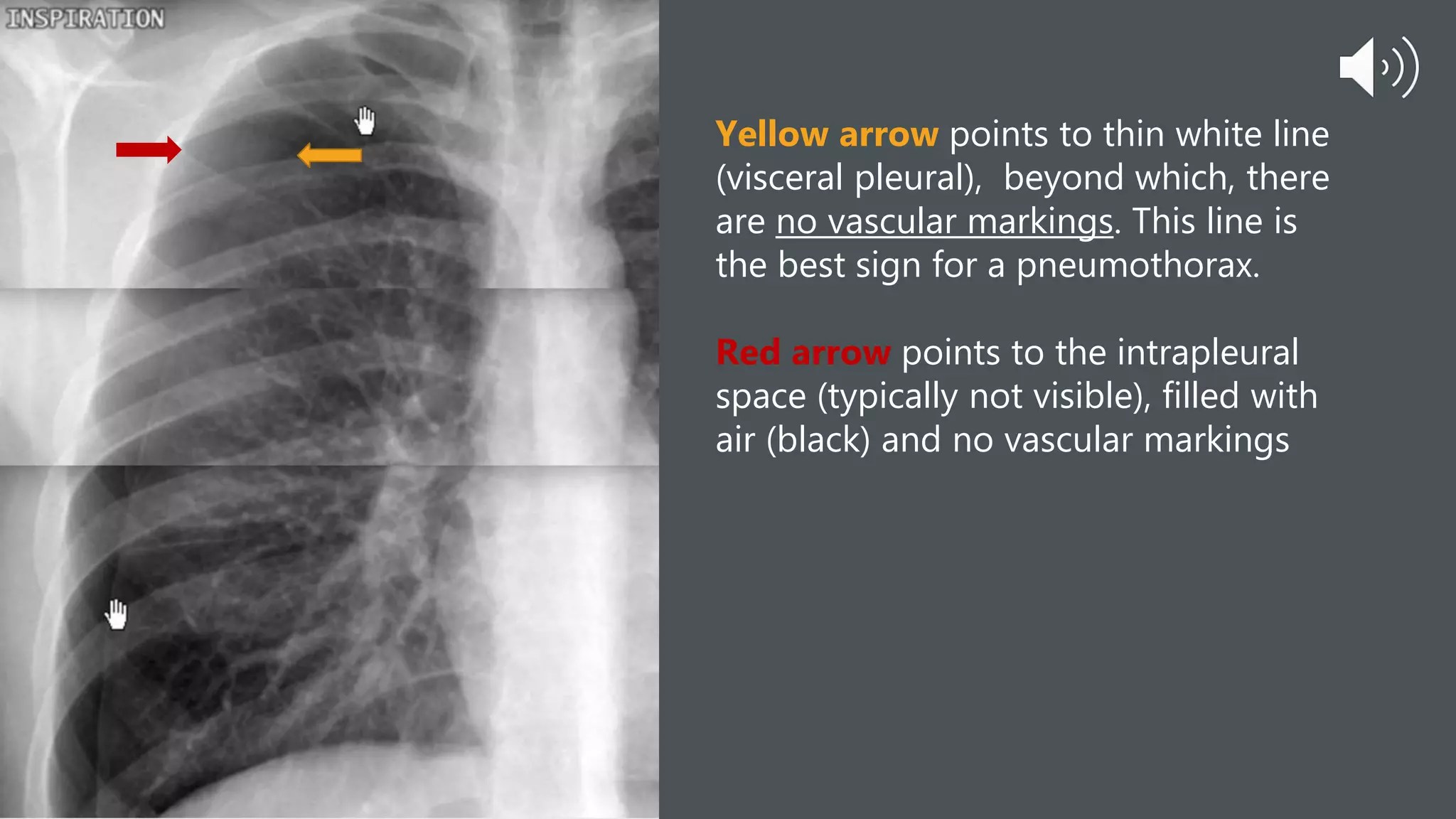 Pneumothorax | PPTX