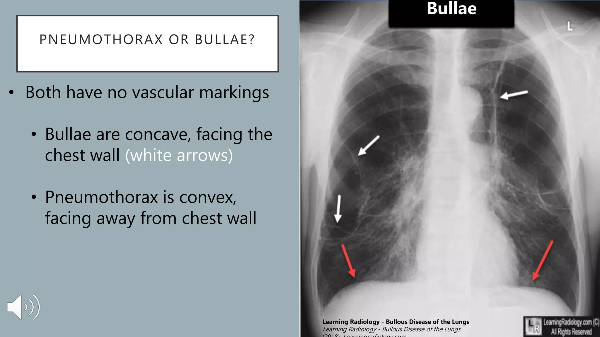 Pneumothorax | PPTX