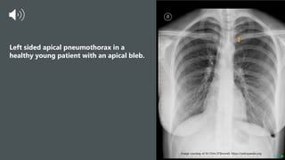 Pneumothorax | PPTX
