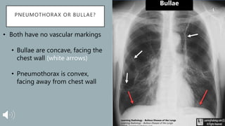 Pneumothorax | PPTX