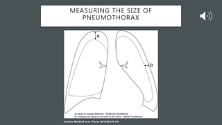 Pneumothorax | PPTX