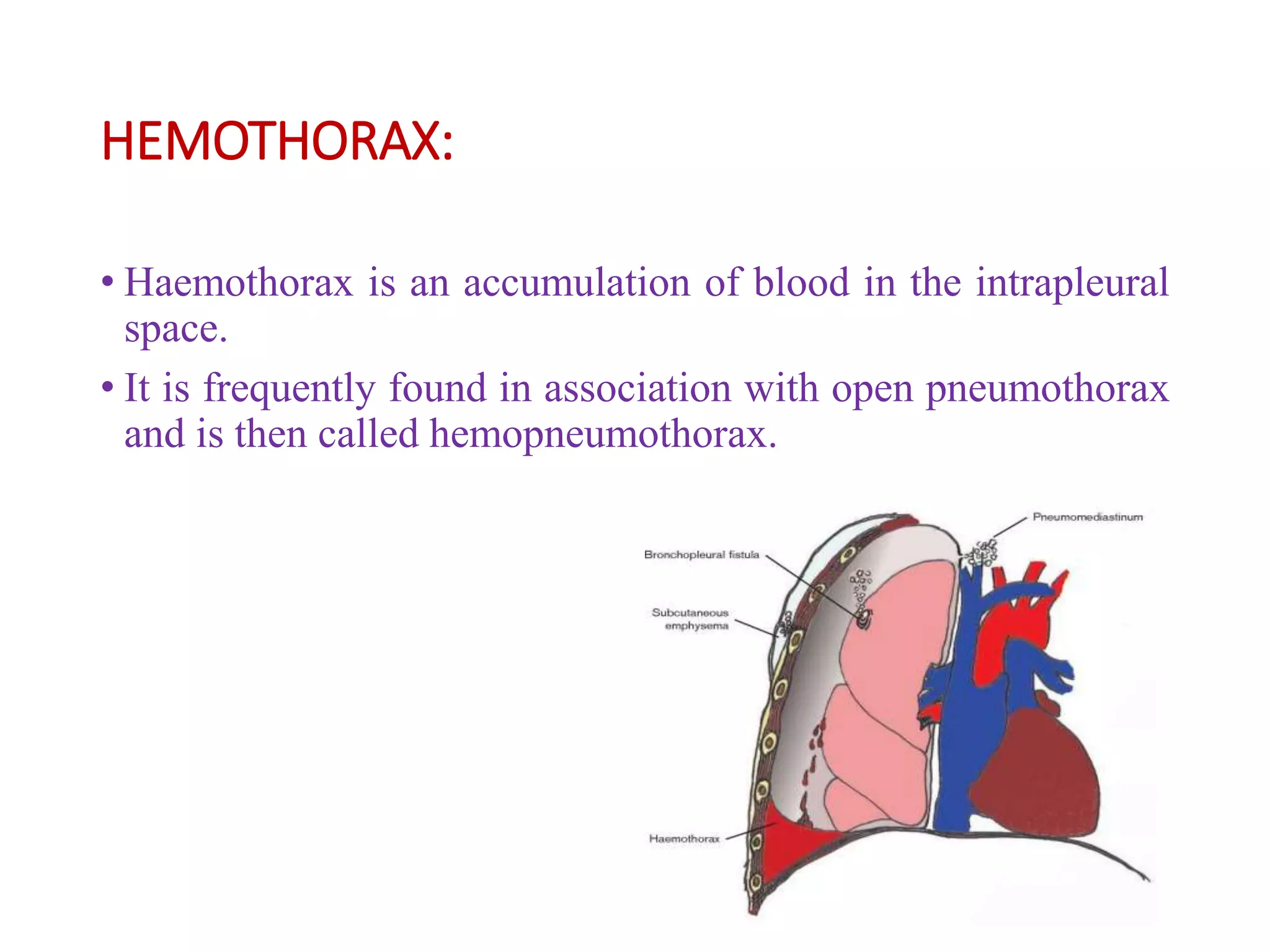 Pneumothorax & Haemothorax | PPTX