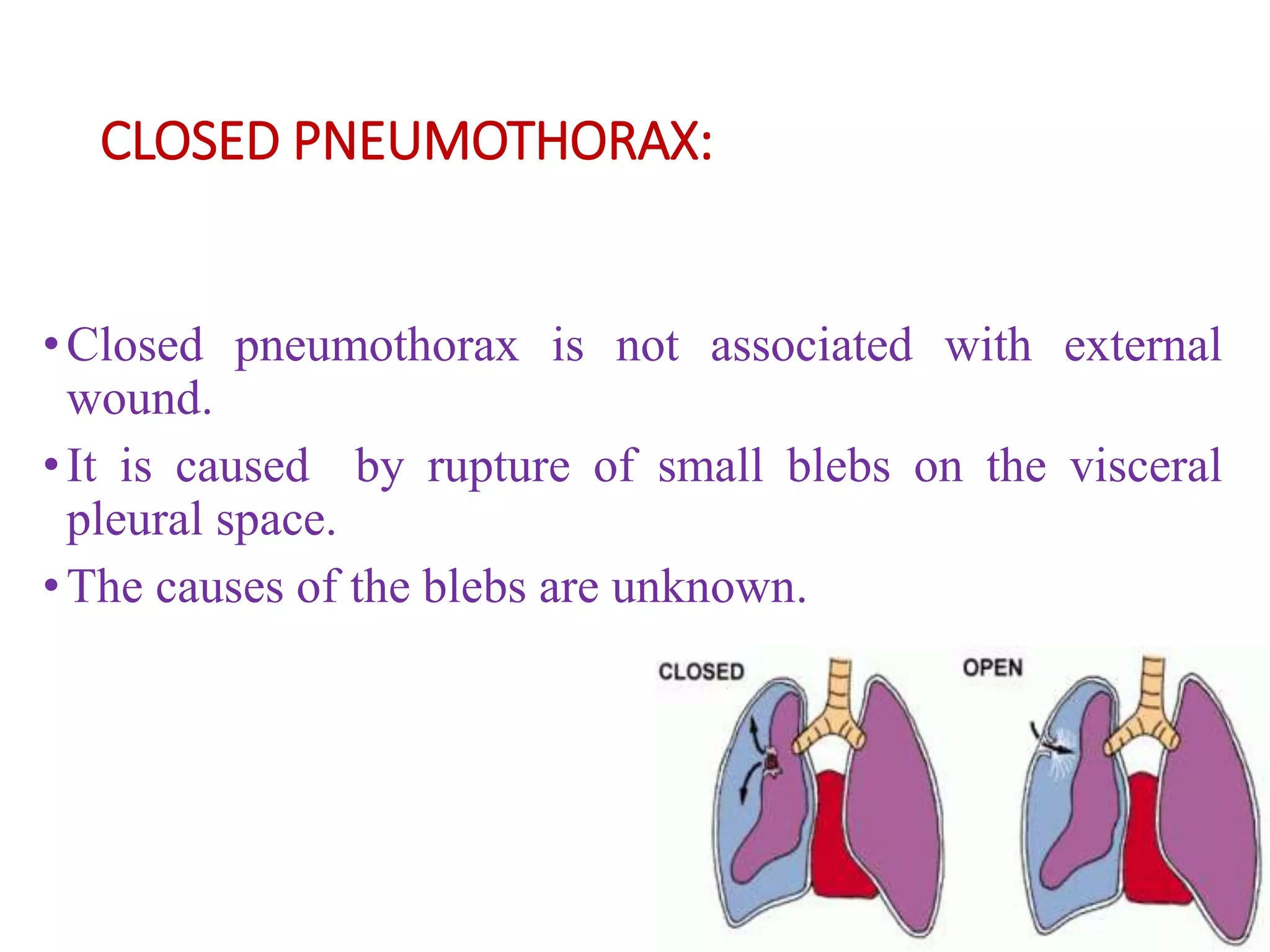 Pneumothorax & Haemothorax | PPTX
