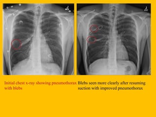 Pneumothorax | PPTX
