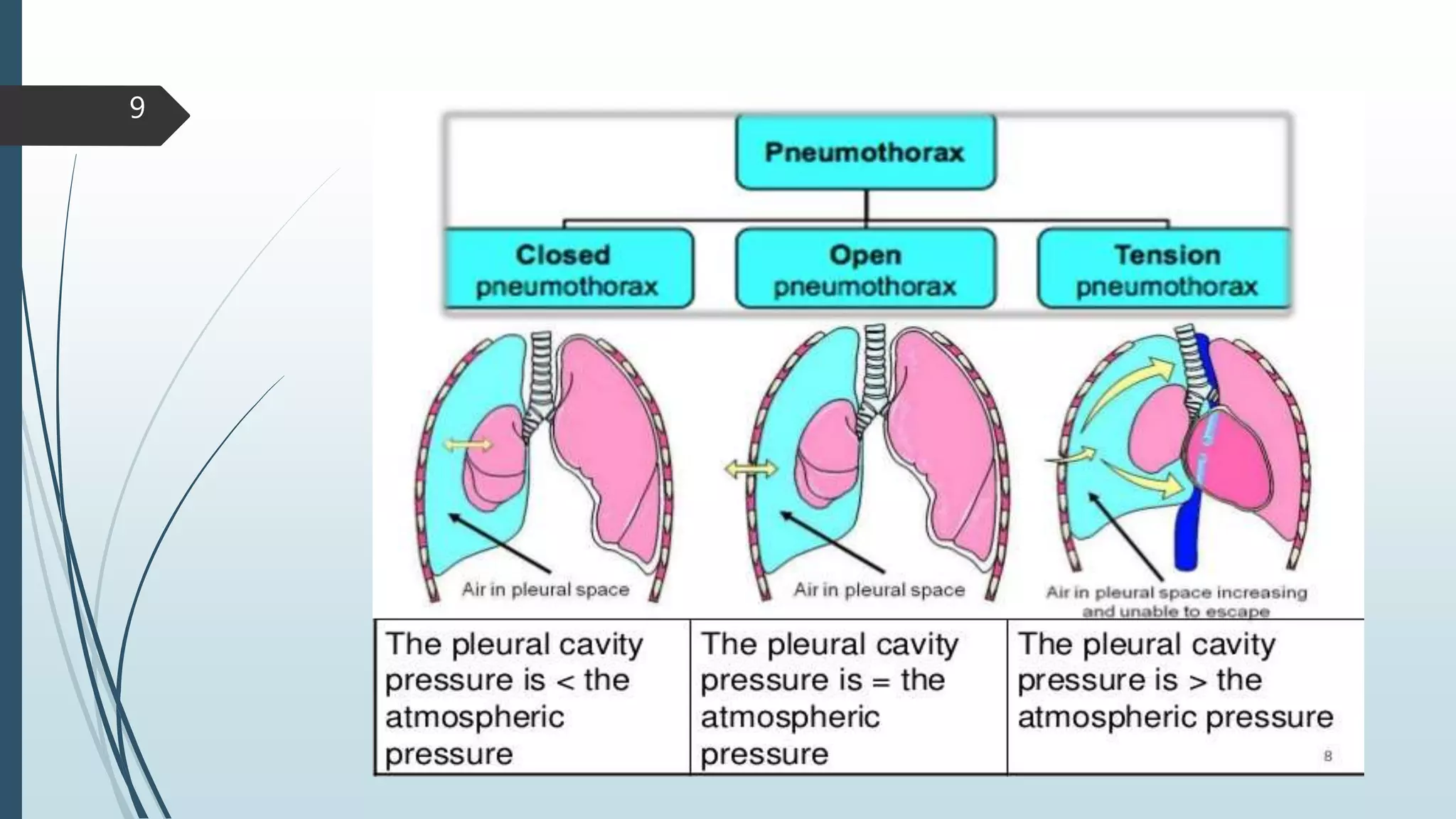 Physiotherapy management in Pneumothorax | PPTX