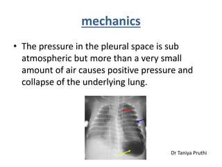 Pneumothorax | PPTX