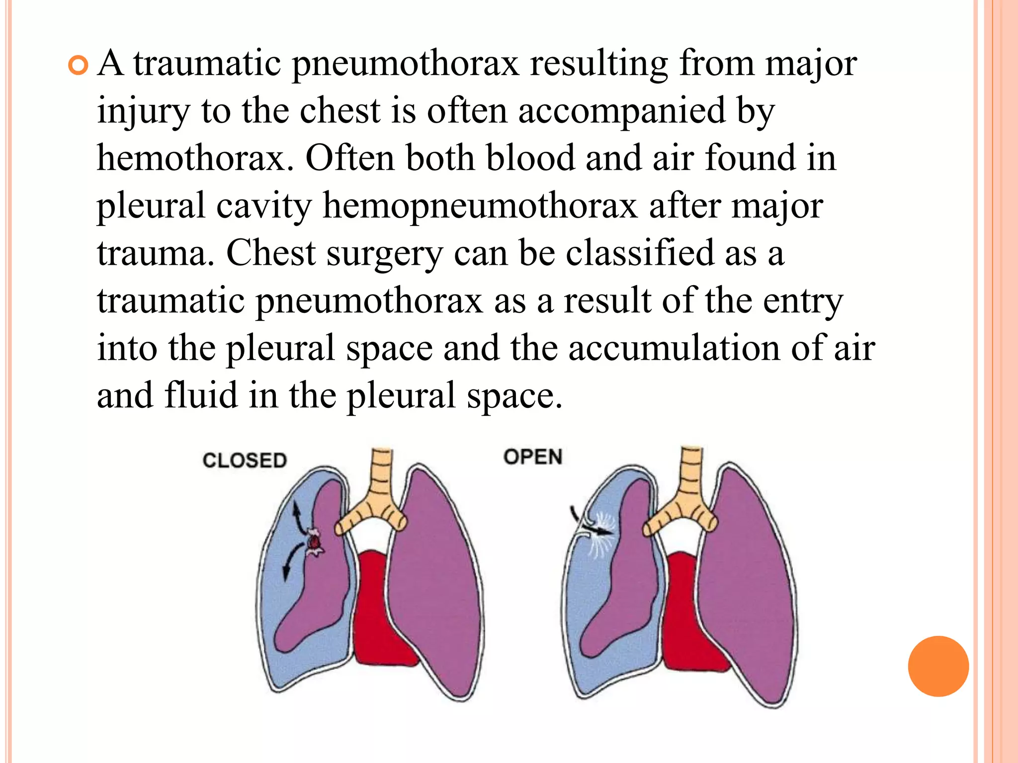 Pneumothorax | PPTX
