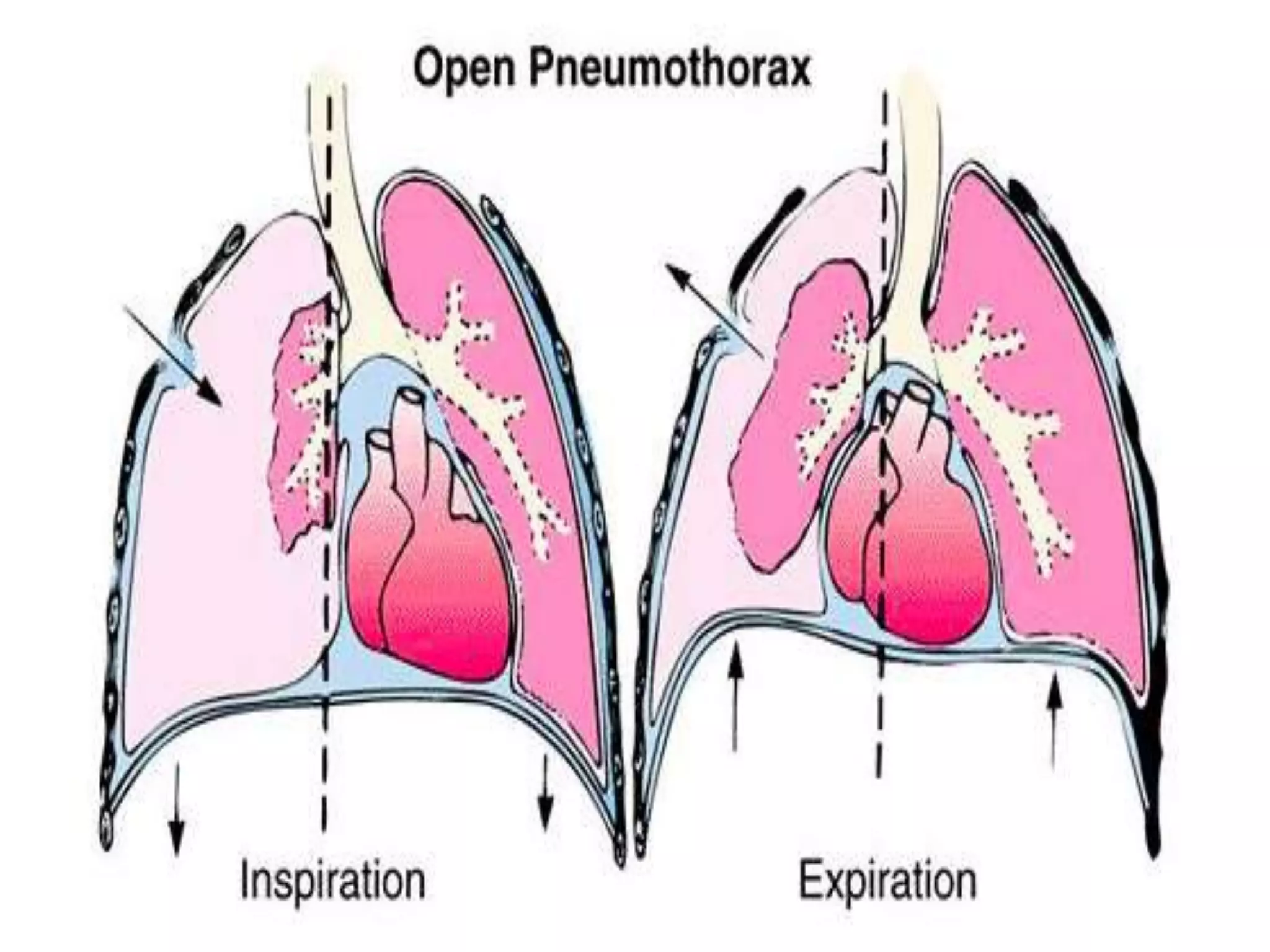 Pneumothorax | PPTX
