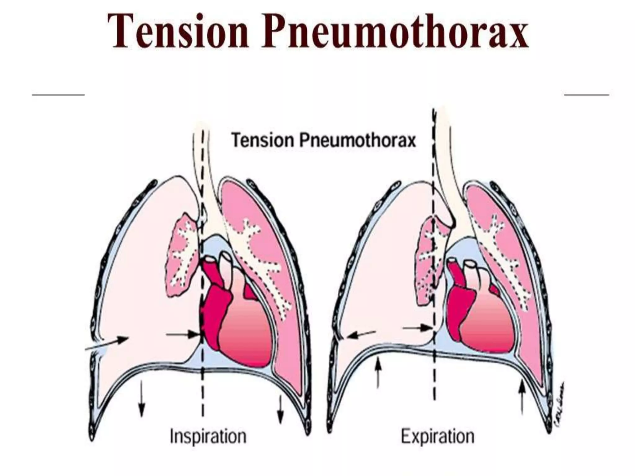 Pneumothorax | PPTX