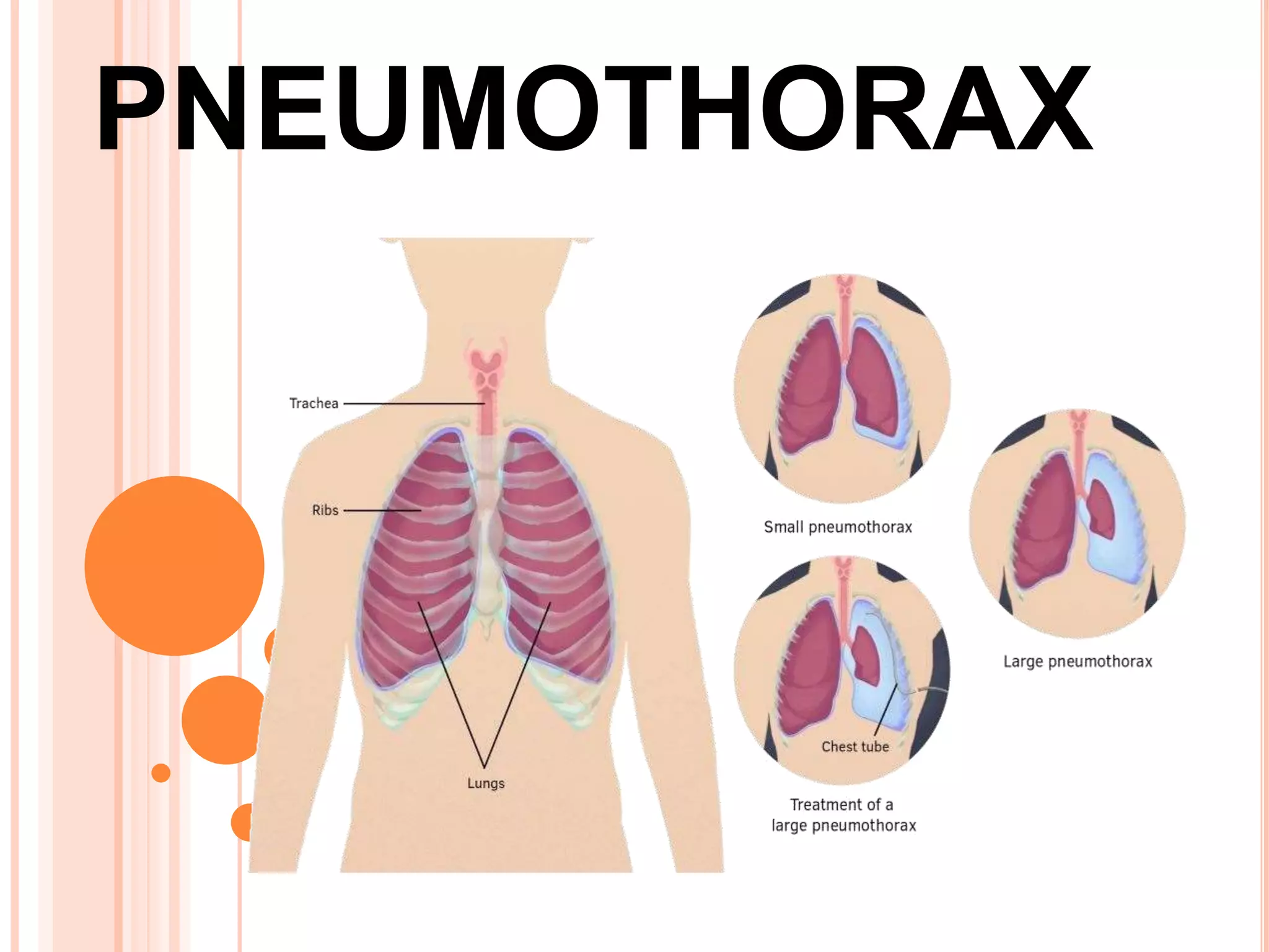 Pneumothorax | PPTX