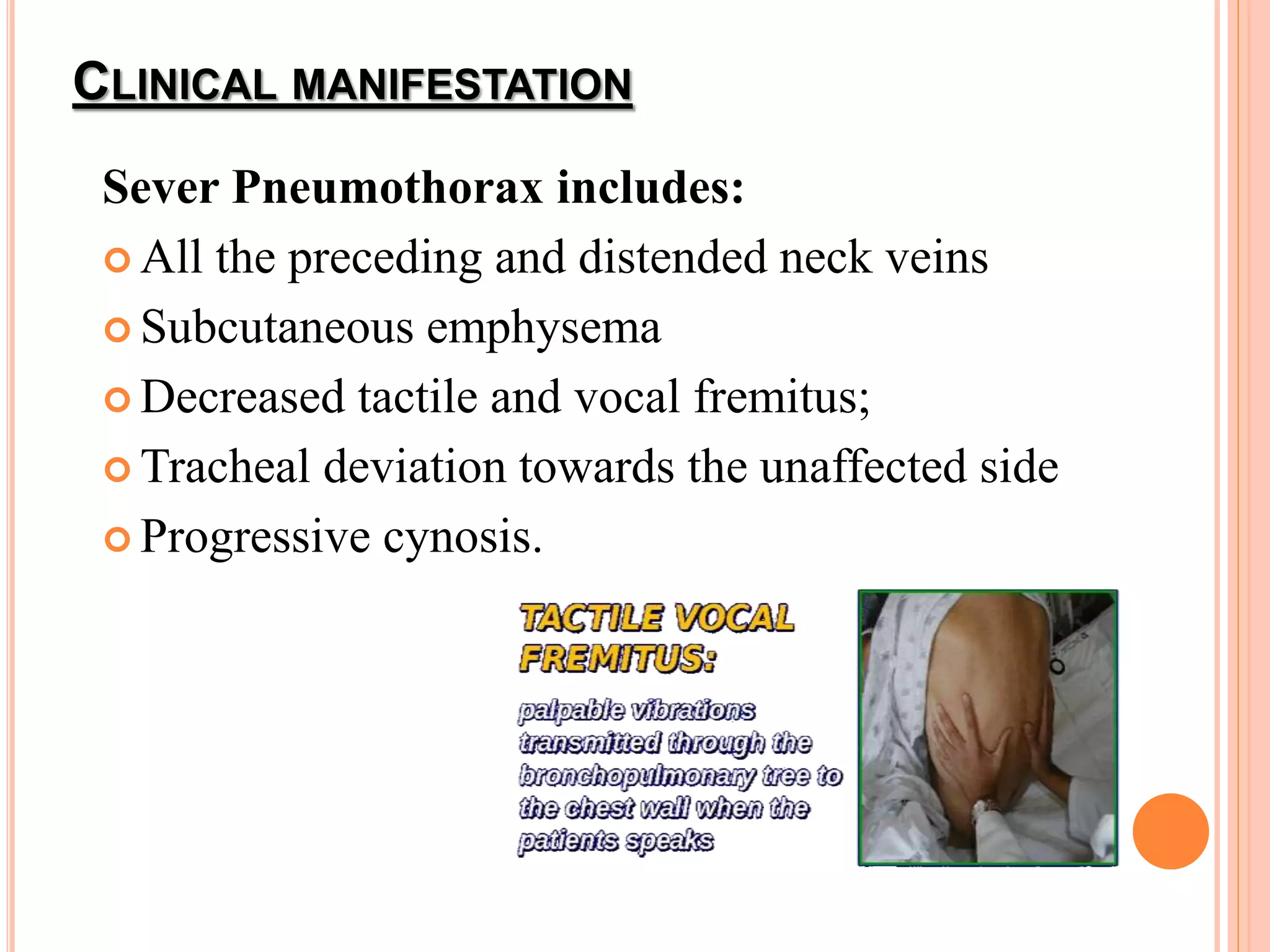 Pneumothorax | PPTX