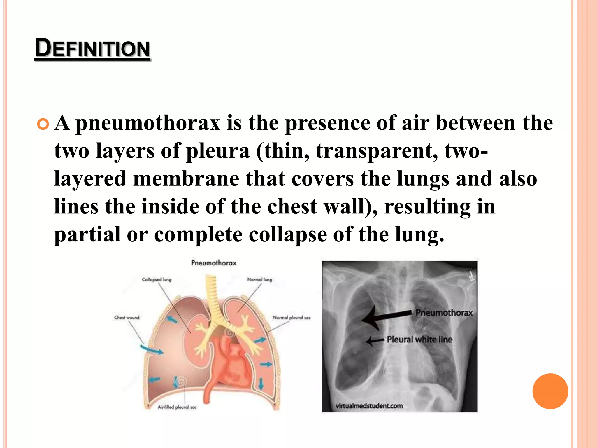 Pneumothorax | PPTX