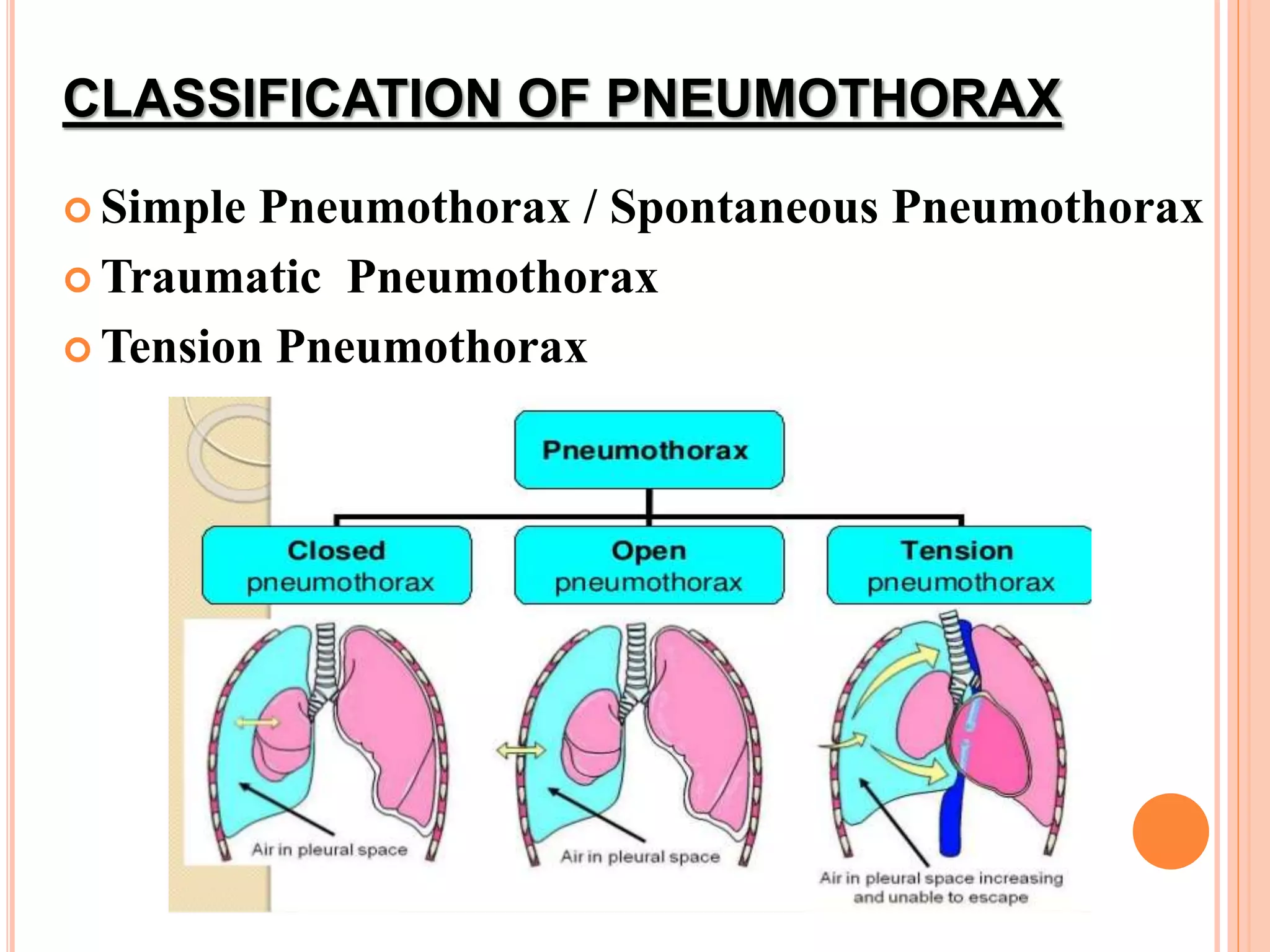 Pneumothorax | PPTX