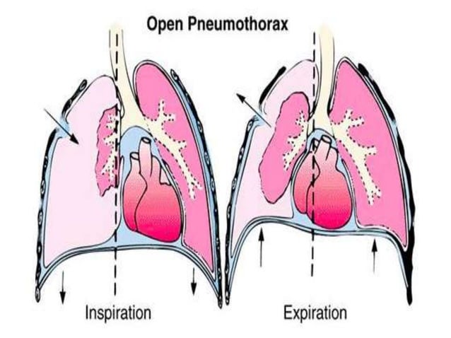 Pneumothorax | PPTX