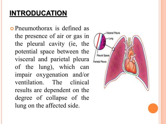 Pneumothorax | PPTX