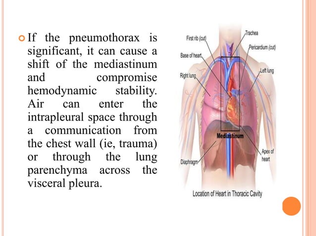 Pneumothorax | PPTX