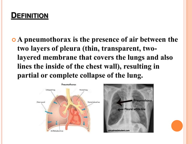 Pneumothorax | PPTX