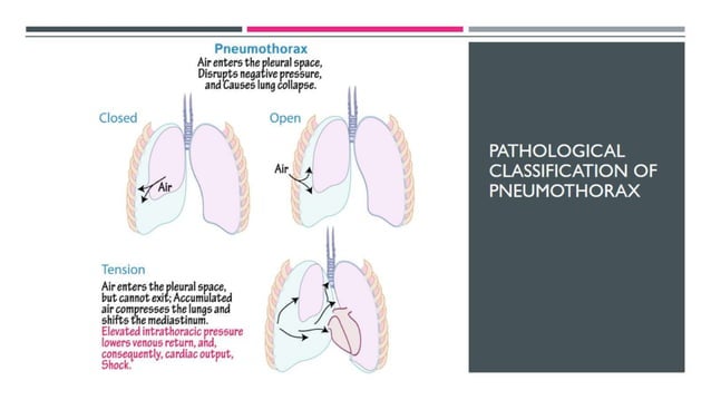 Pneumothorax for Undergraduates | PPTX | Lung and Respiratory Health ...