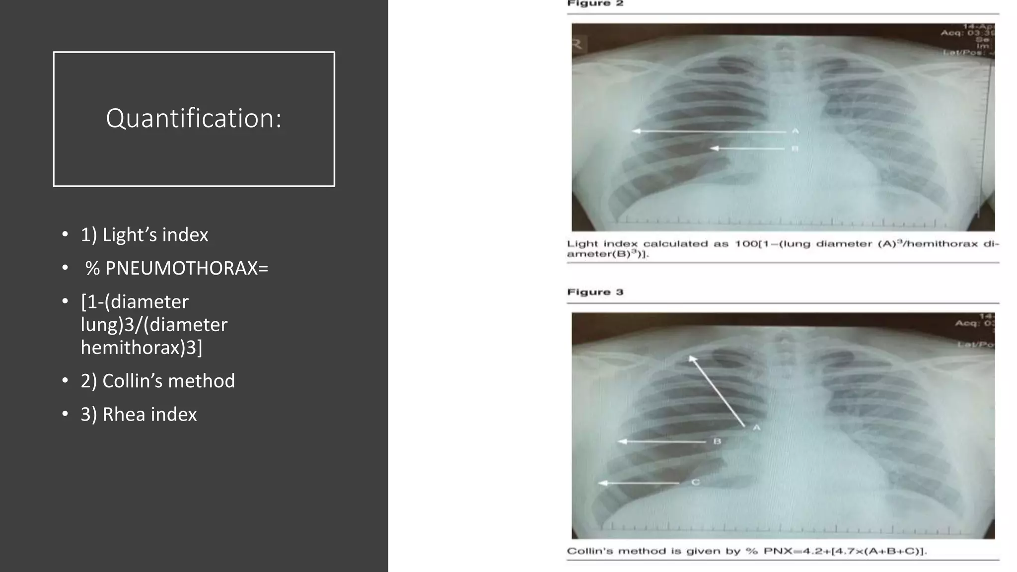 Pneumothorax | PPTX