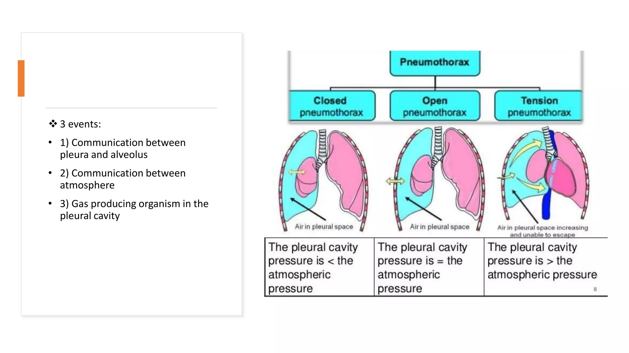 Pneumothorax | PPTX
