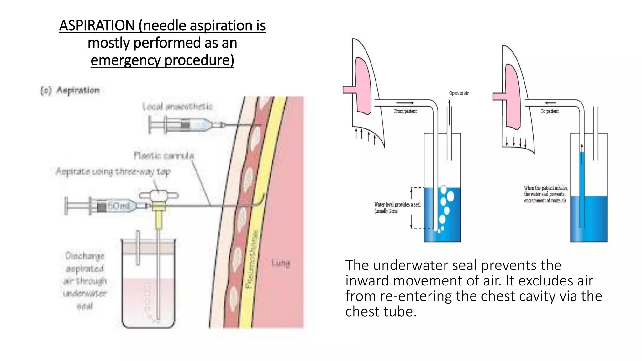 Pneumothorax | PPTX