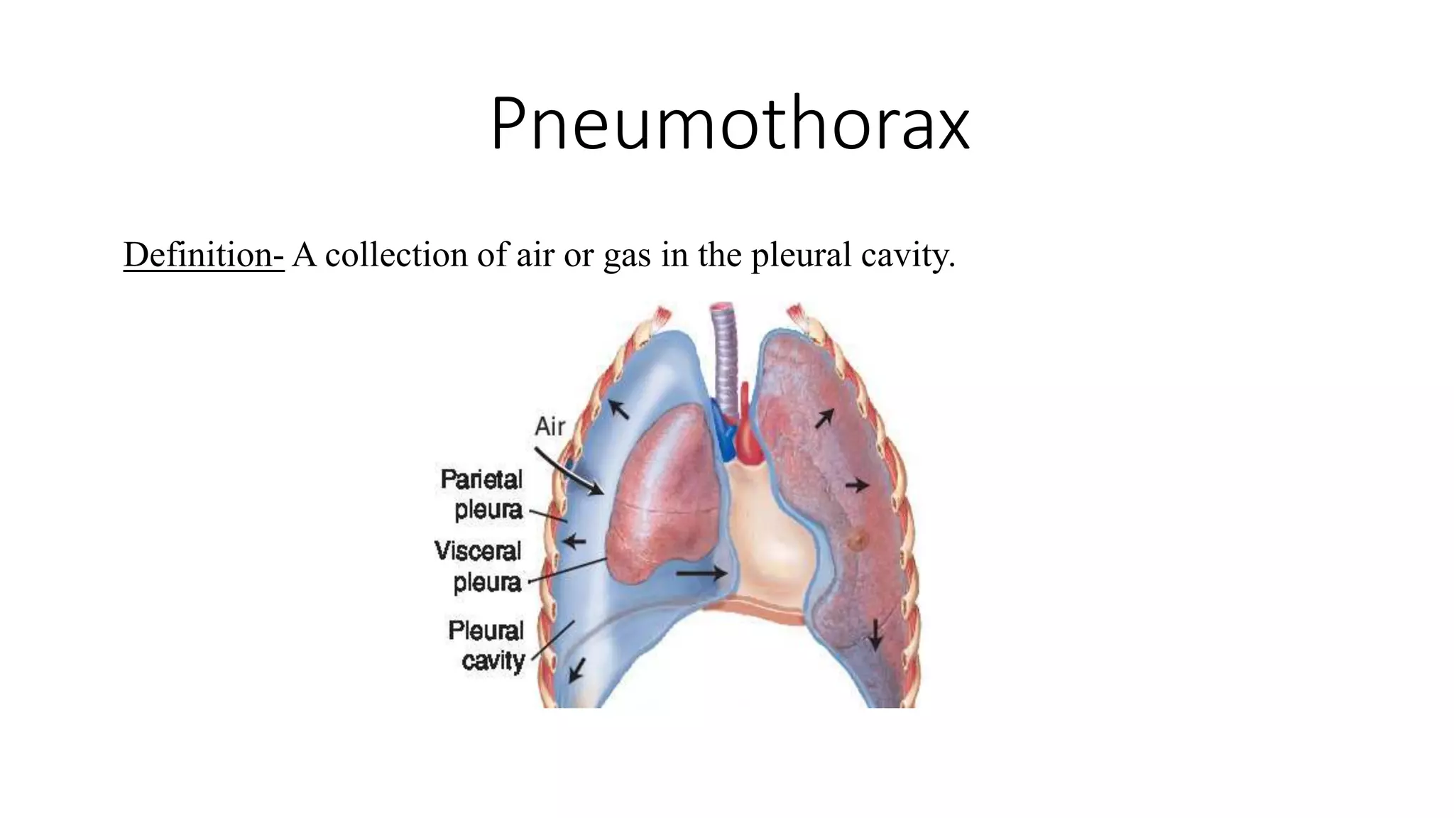 Pneumothorax | PPTX