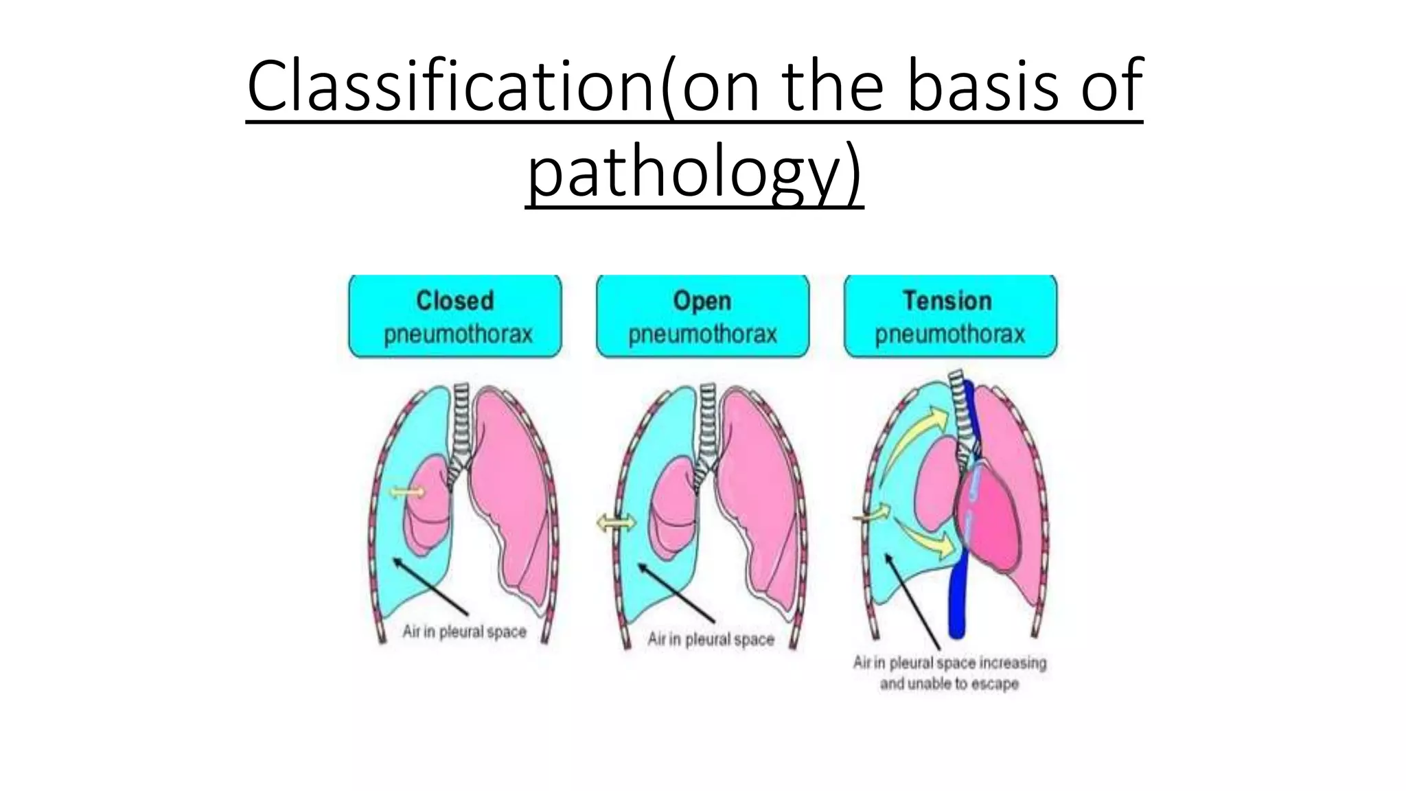 Pneumothorax | PPTX