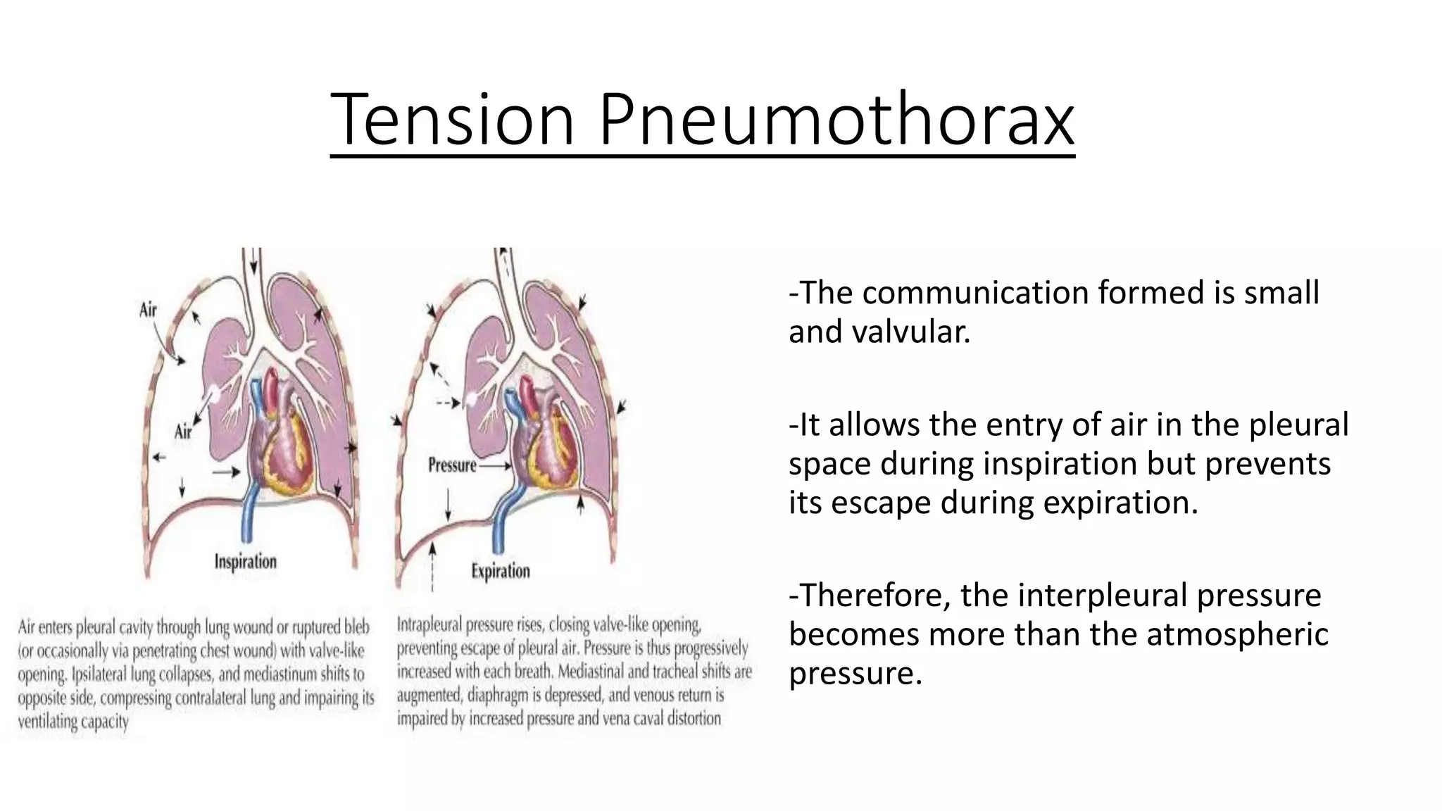 Pneumothorax | PPTX