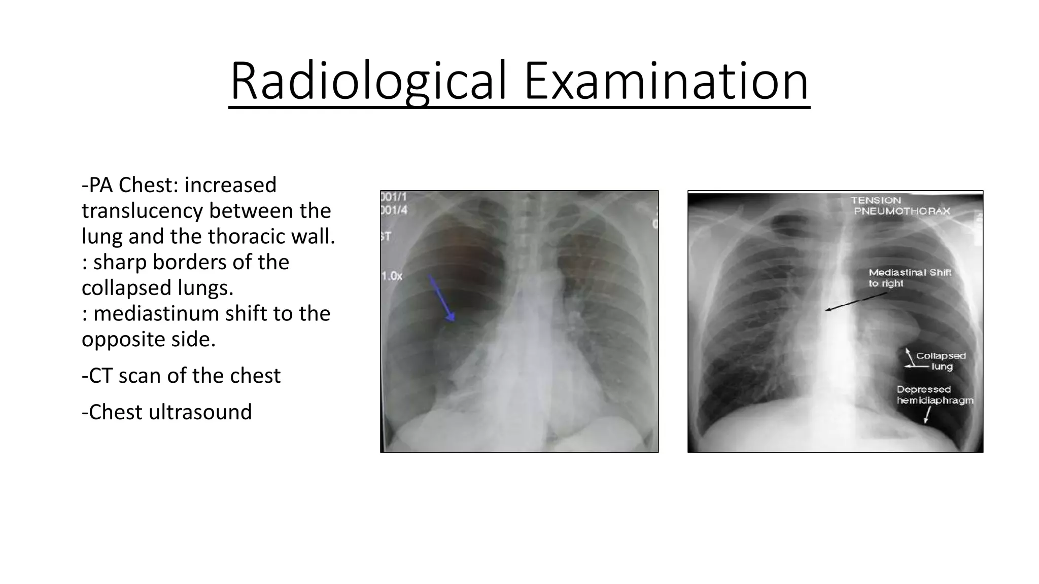 Pneumothorax | PPTX