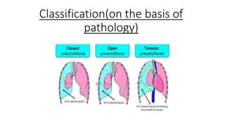 Pneumothorax | PPTX