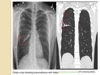 Pneumothorax.pptx