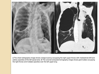 Pneumothorax and Physiotherapy management .pptx