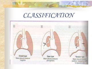 PNEUMOTHORAX.ppt
