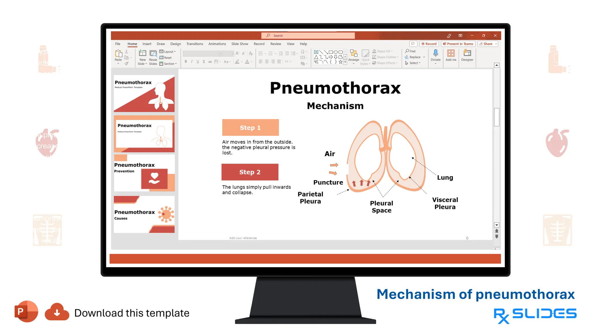 pneumothorax | PDF