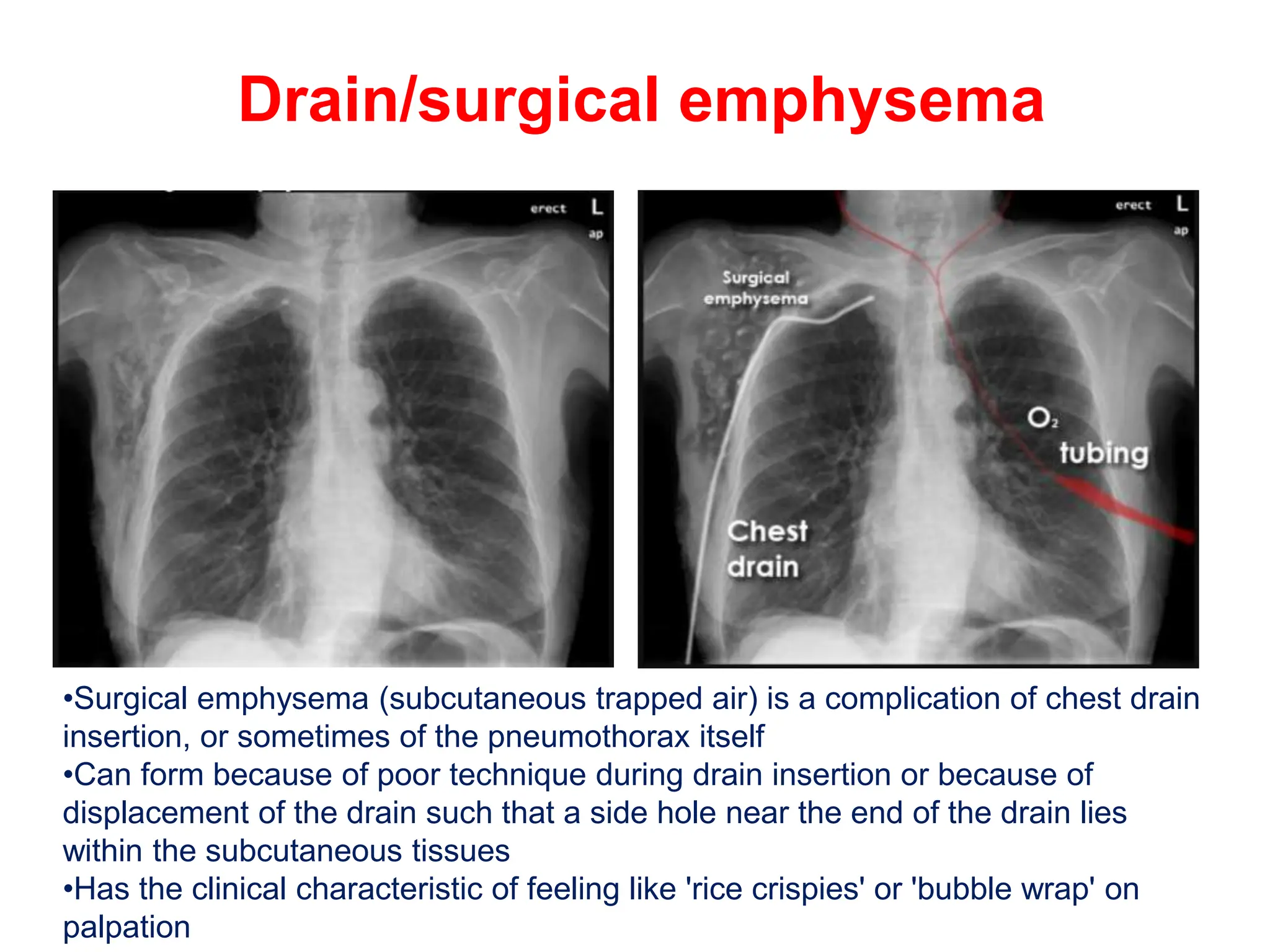 PNEUMOTHORAX IN CHEST XRAY INTERPRETATIONpptx | PPTX