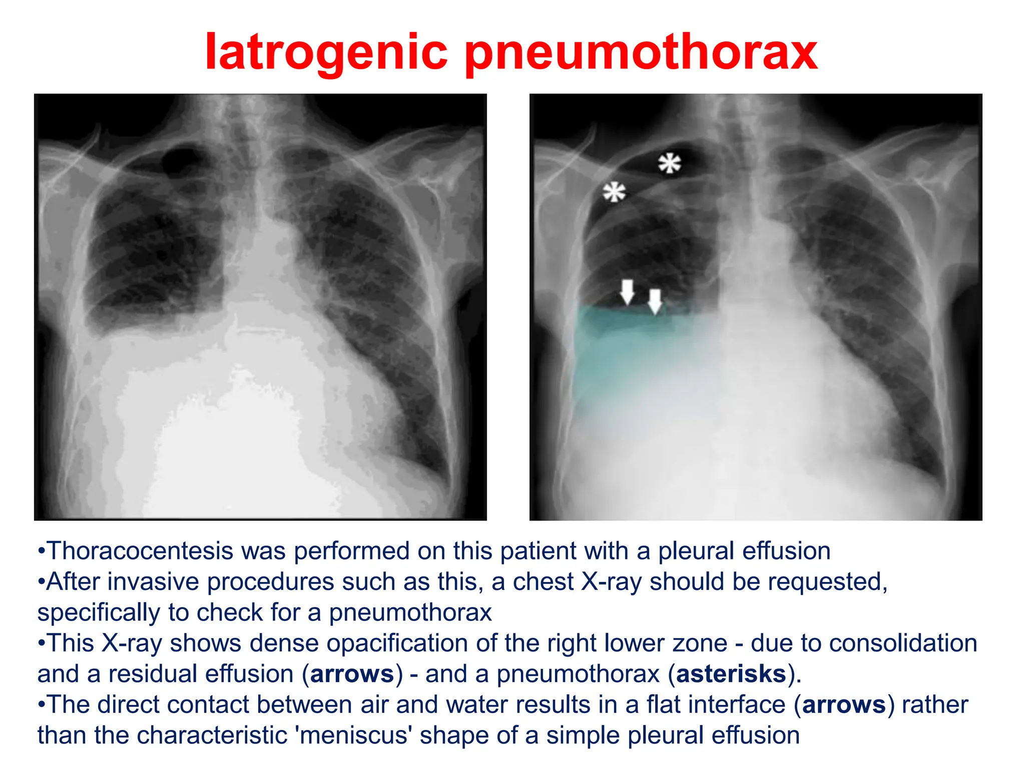 PNEUMOTHORAX IN CHEST XRAY INTERPRETATIONpptx | PPTX