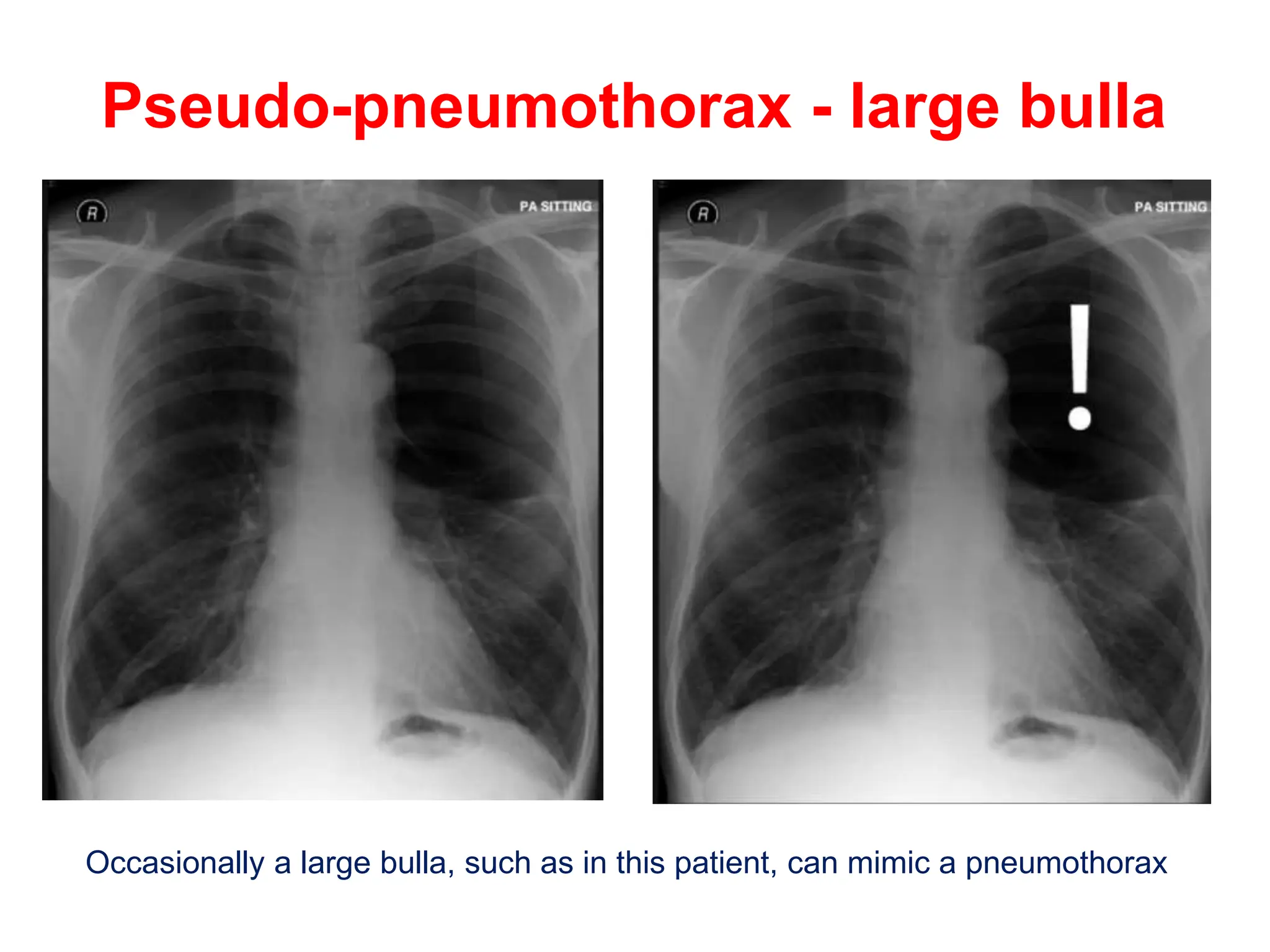 PNEUMOTHORAX IN CHEST XRAY INTERPRETATIONpptx | PPTX