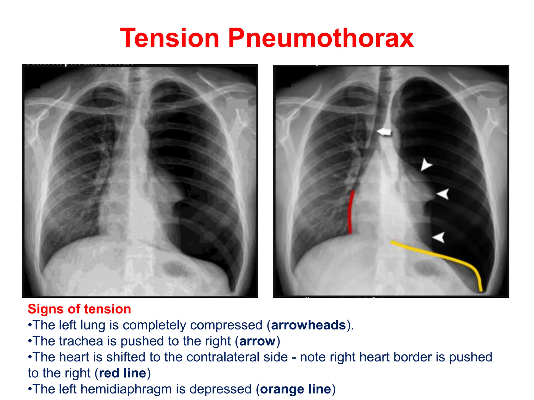 PNEUMOTHORAX IN CHEST XRAY INTERPRETATIONpptx | PPTX