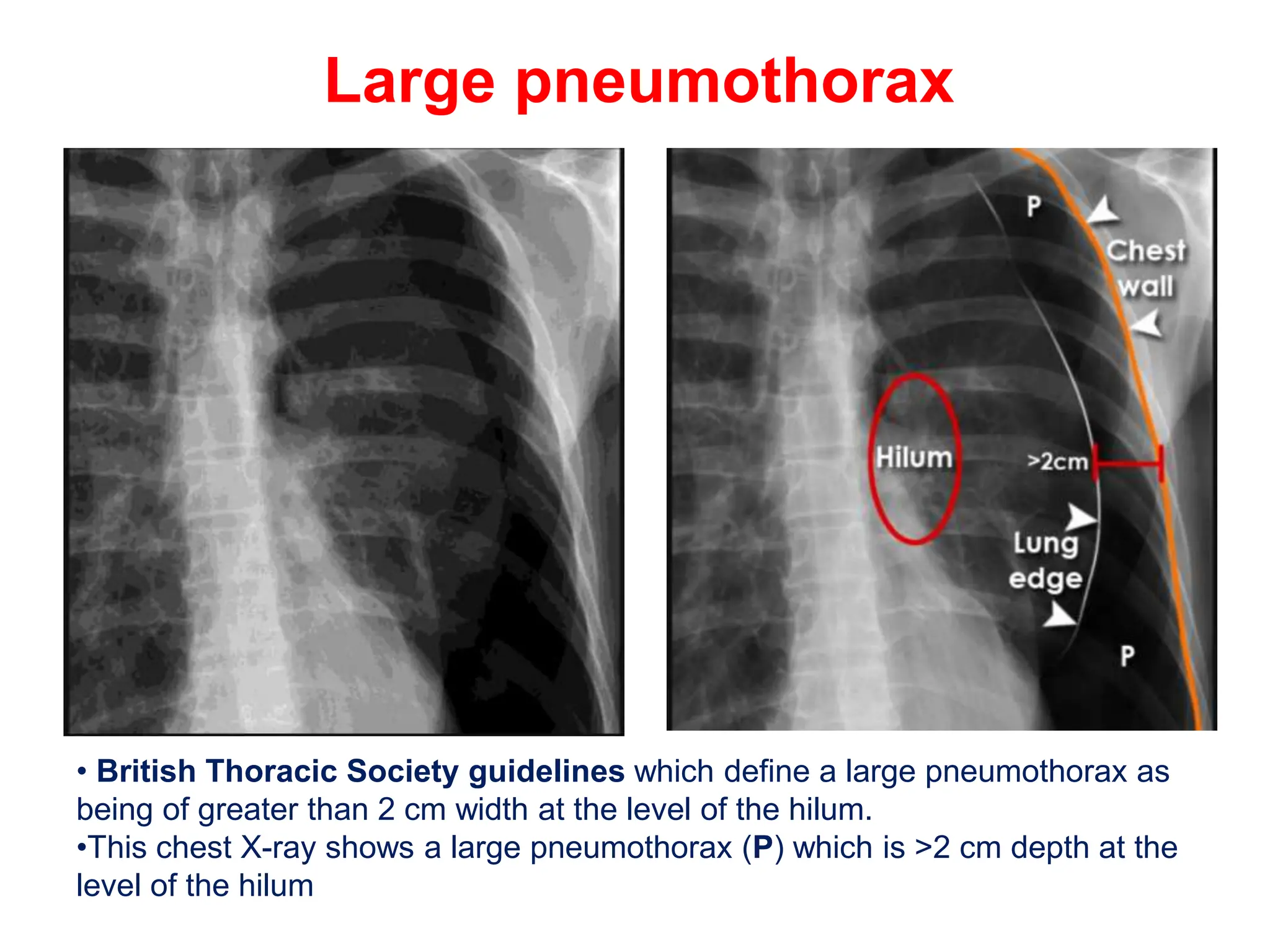 PNEUMOTHORAX IN CHEST XRAY INTERPRETATIONpptx | PPTX
